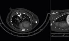 ExiTron™ ultra 18000 - MediLumine