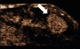 PolySon™ T - MediLumine
